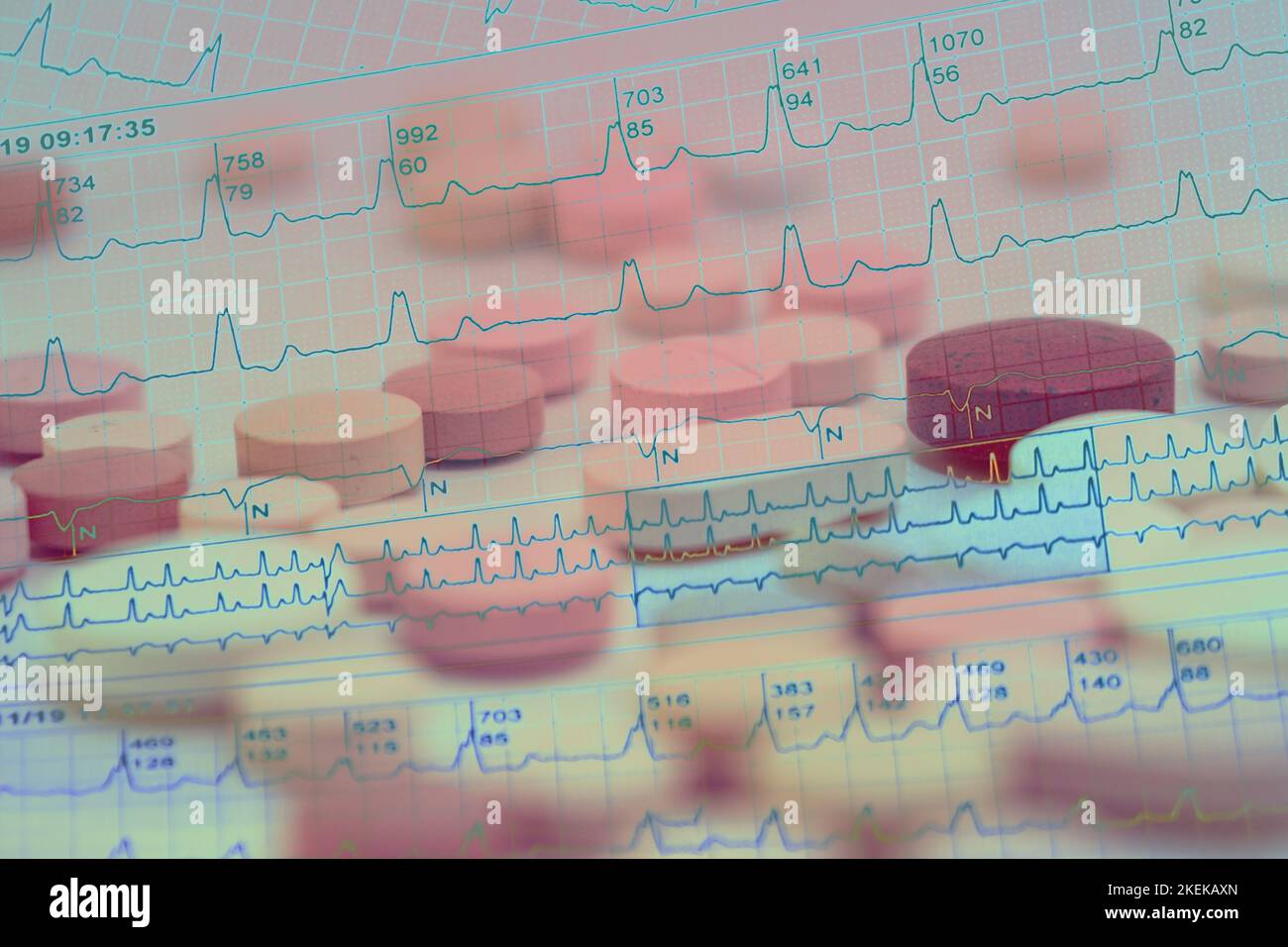 electrocardiogram with atrial fibrillation superimposed on colored ...