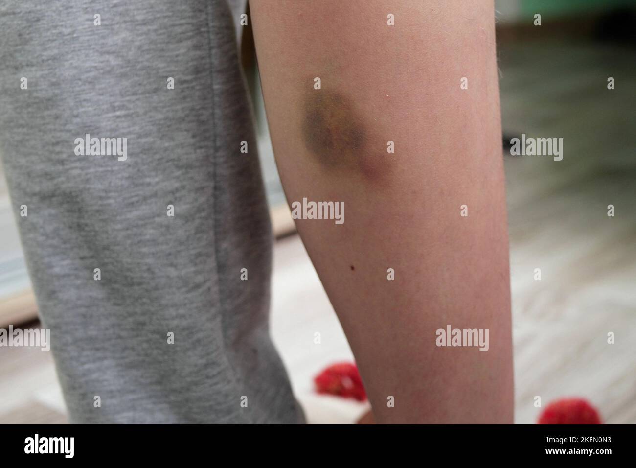 Closeup of hands applying balm to leg. Knee injury, skin hematoma, skin ...