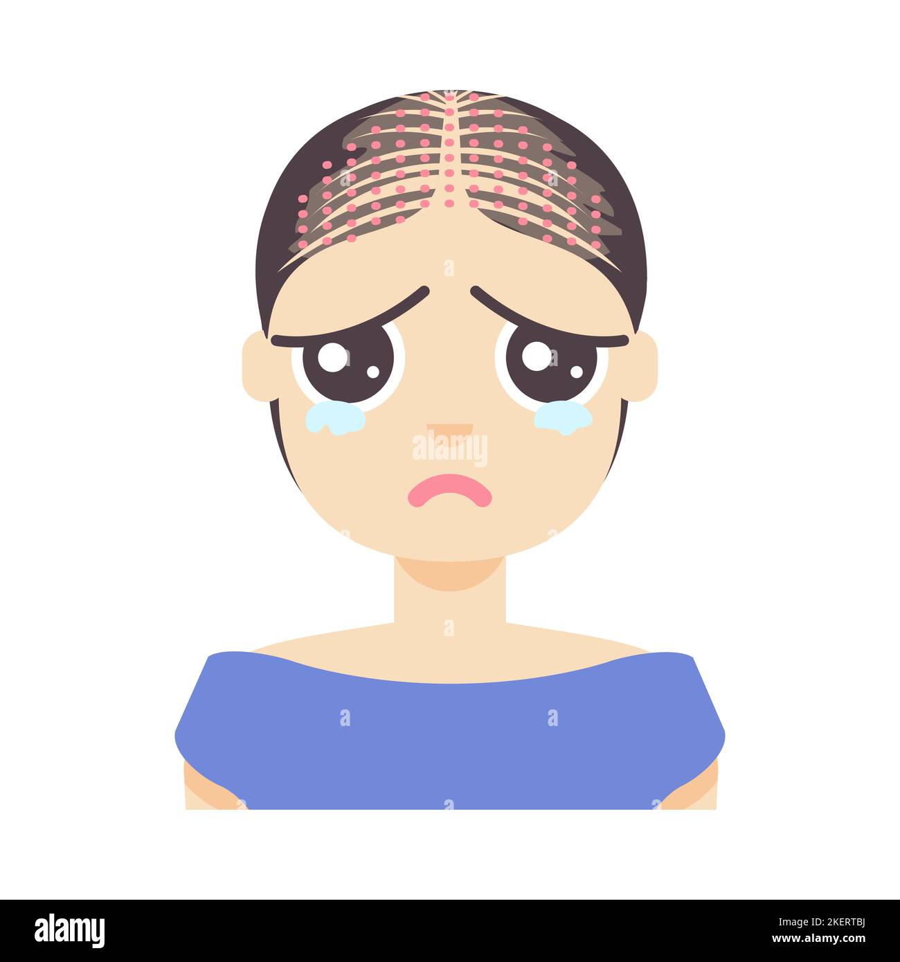 FUE hair transplant treatment of alopecia illustration Stock Vector ...