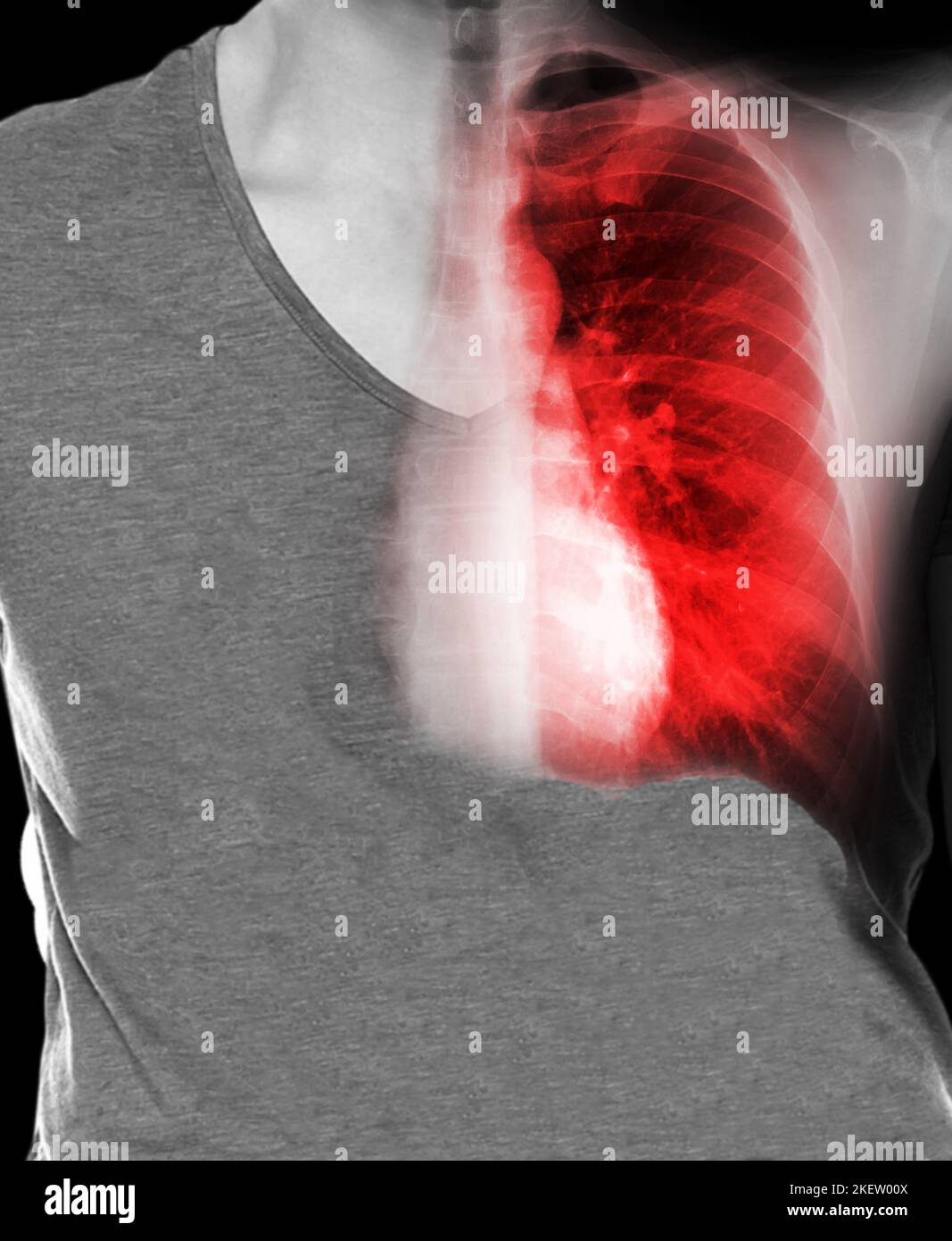 Human Chest With X-ray Chest Imaging Stock Photo - Alamy