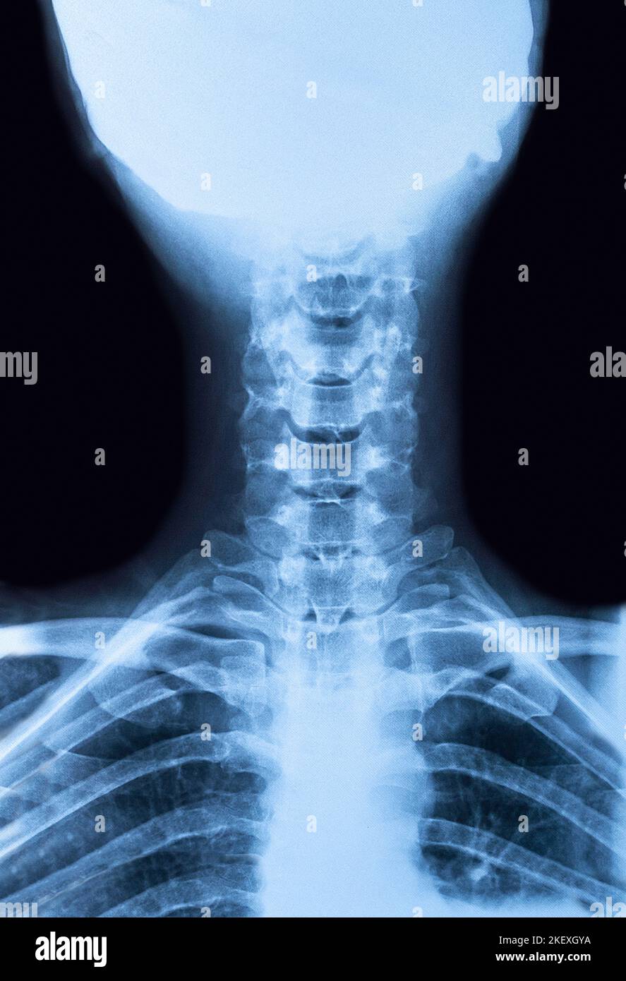 Neck x ray of cervical vertebrae hi-res stock photography and images ...