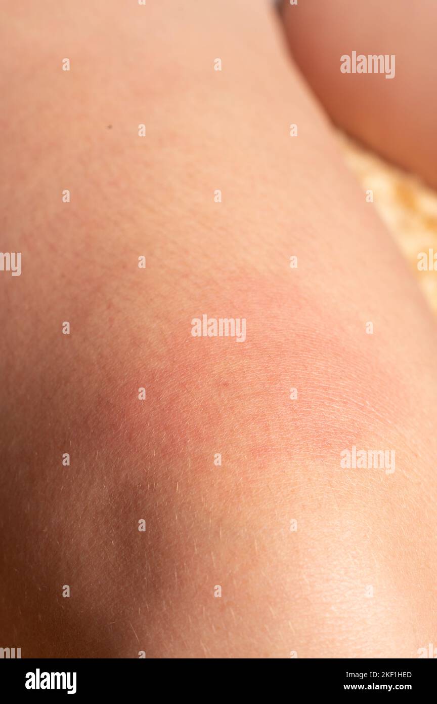 Sepsis skin hi-res stock photography and images - Alamy