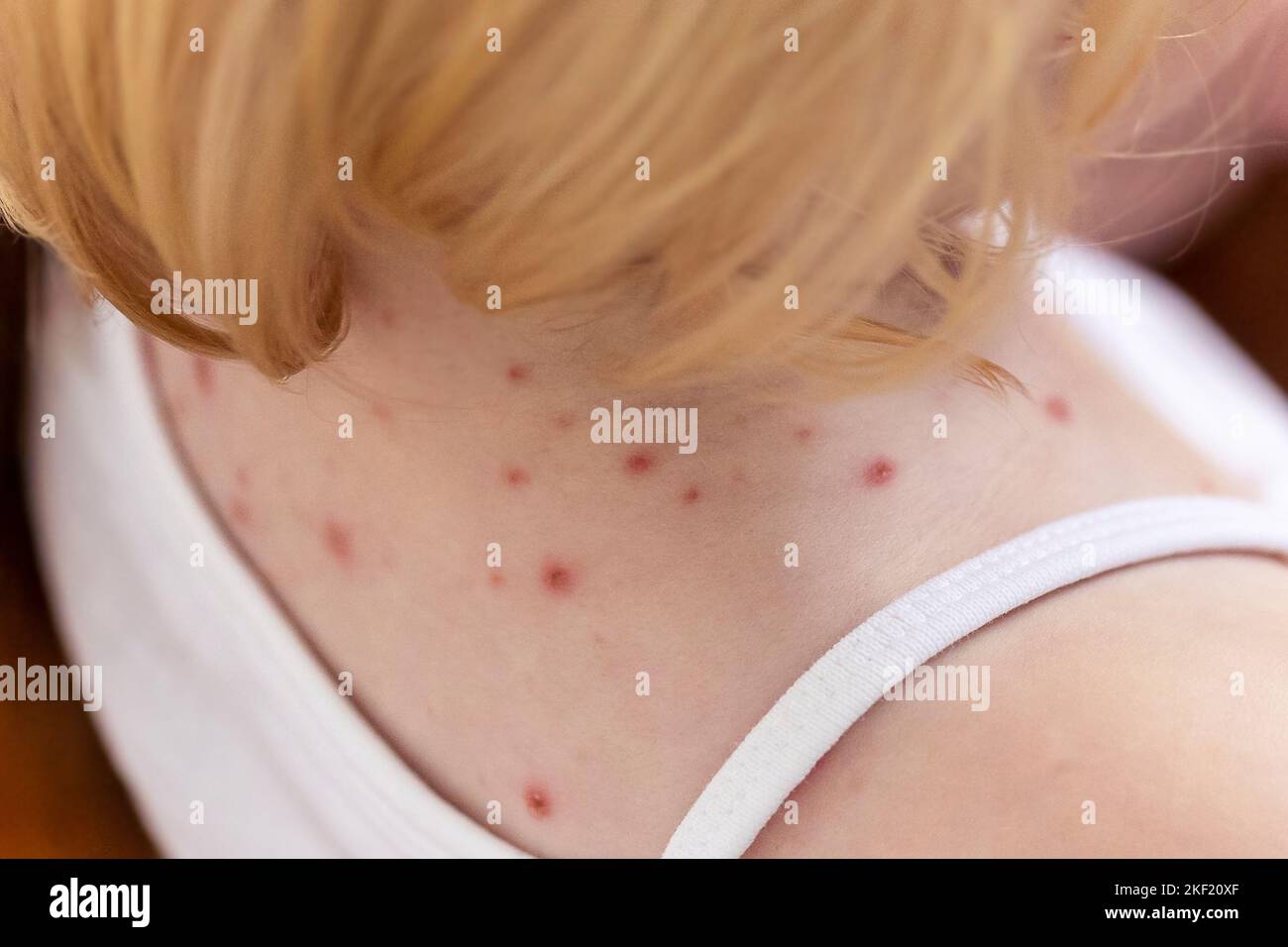 A portrait of the body of a small toddler with the chicken or wind pox ...