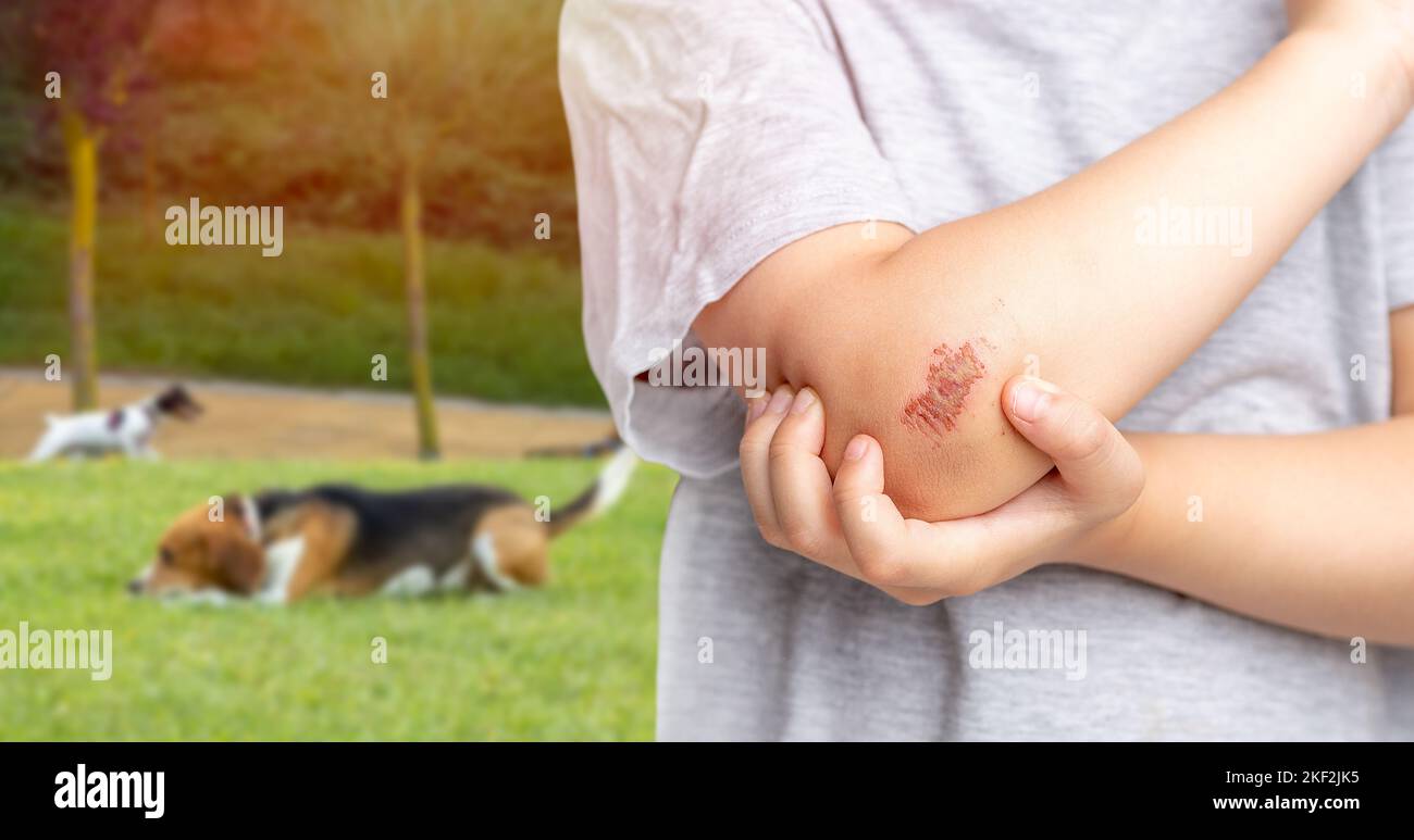 Closeup of an injured elbow of a child who was playing with the dog in ...