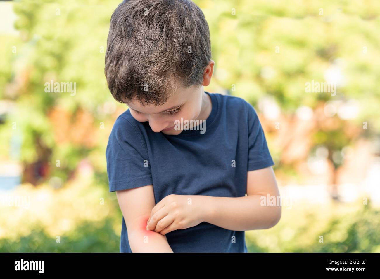Heat rash child hi-res stock photography and images - Alamy