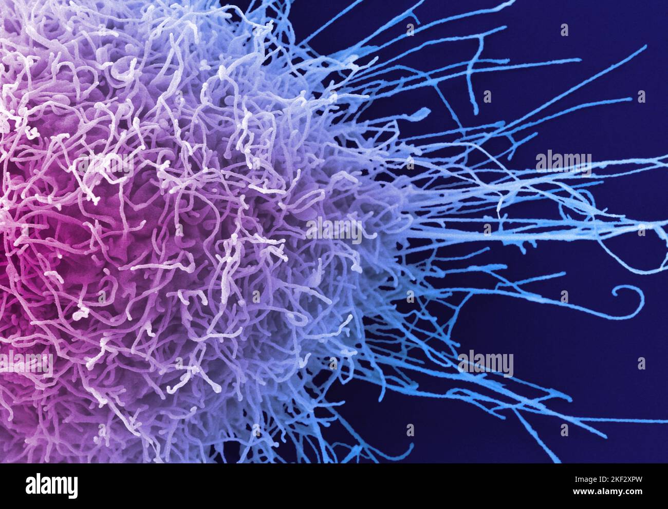 Cervical cancer cell, SEM Stock Photo - Alamy