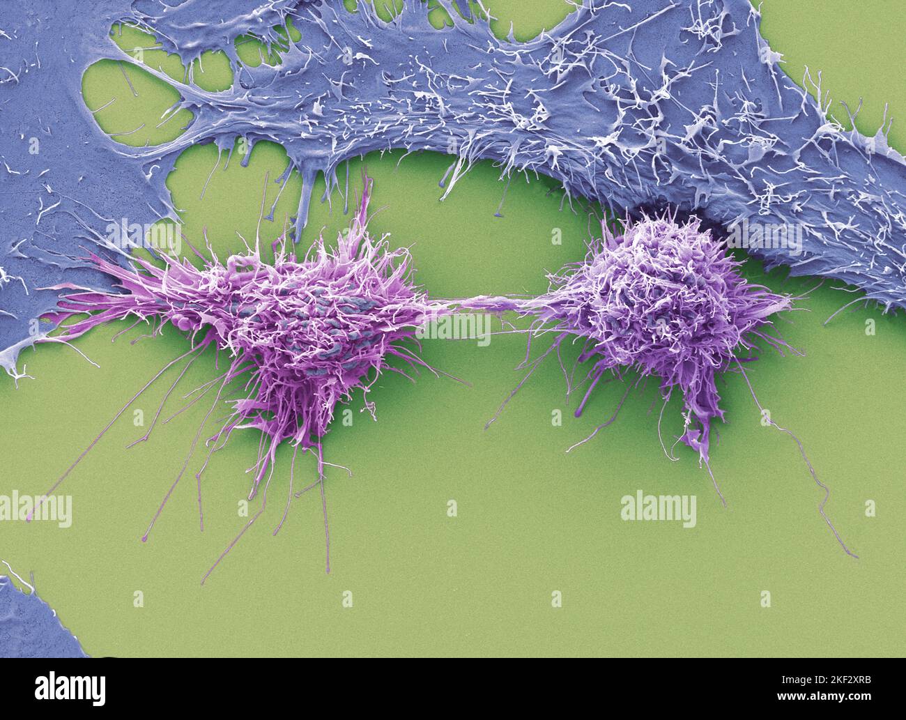 Cervical cancer cells dividing, SEM Stock Photo - Alamy