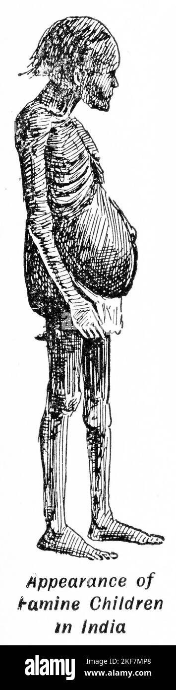Engraving of an Indian child suffering during a famine, circa 1890 ...