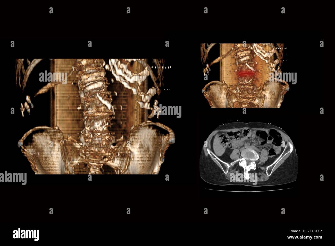 computed tomography of the spine with a fracture of the vertebrae and ...