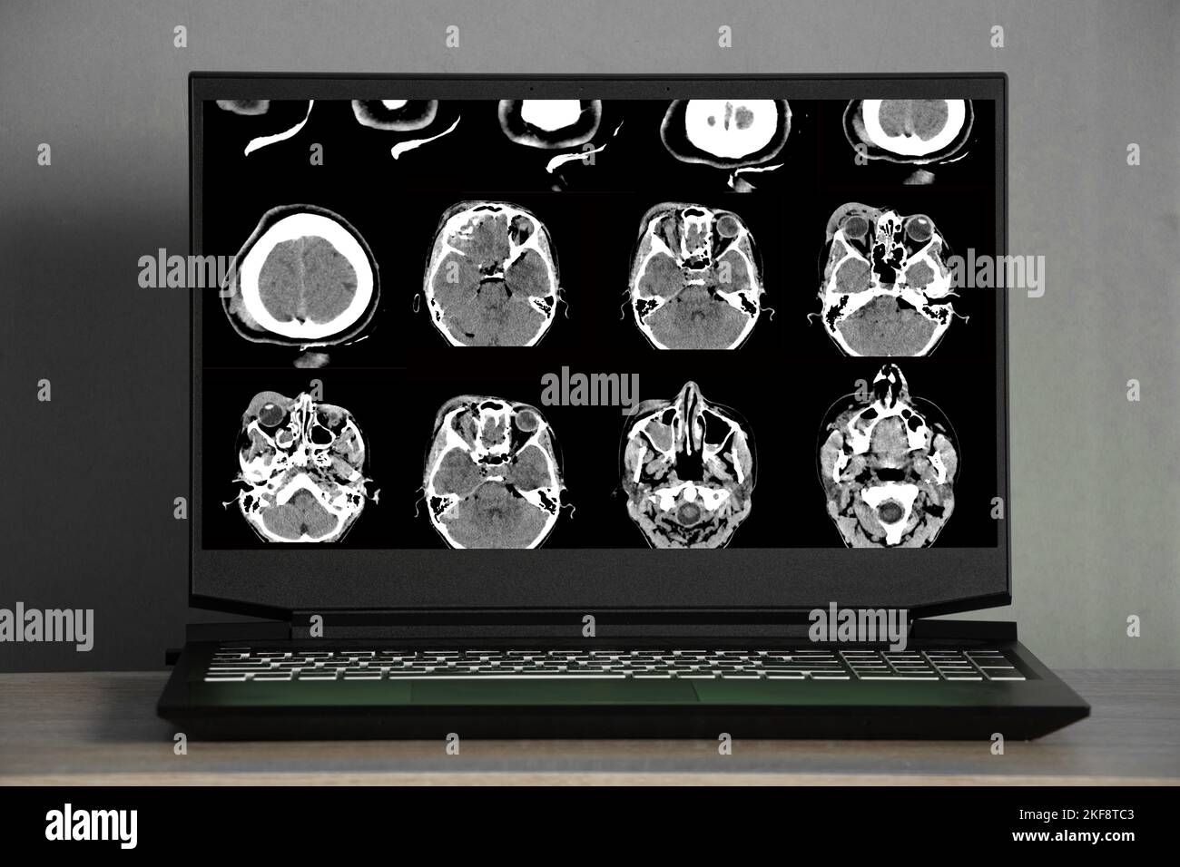 3d computed tomography of the brain with a fracture of the frontal part ...