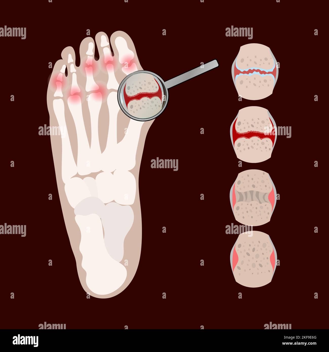 ARTHRITIS LEG Rheumatoid Chronic Disease Medicine Education Diagram ...
