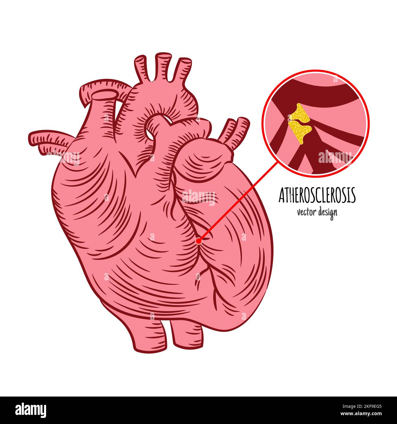 ATHEROSCLEROSIS Chronic Disease Medicine Education Diagram Vector ...