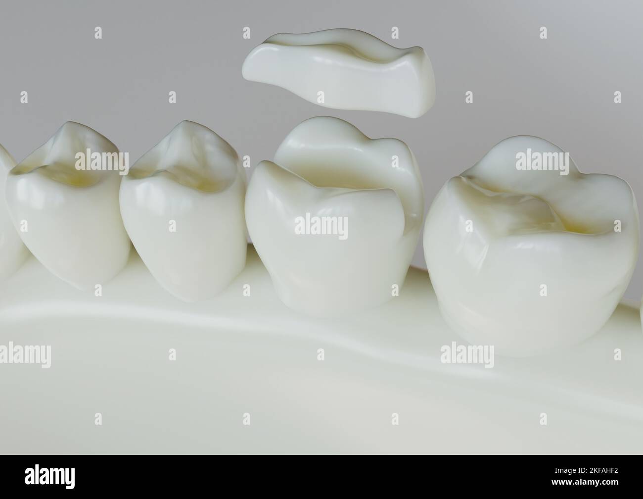 Ceramic Inlay crown over a tooth- 3D Rendering Stock Photo - Alamy