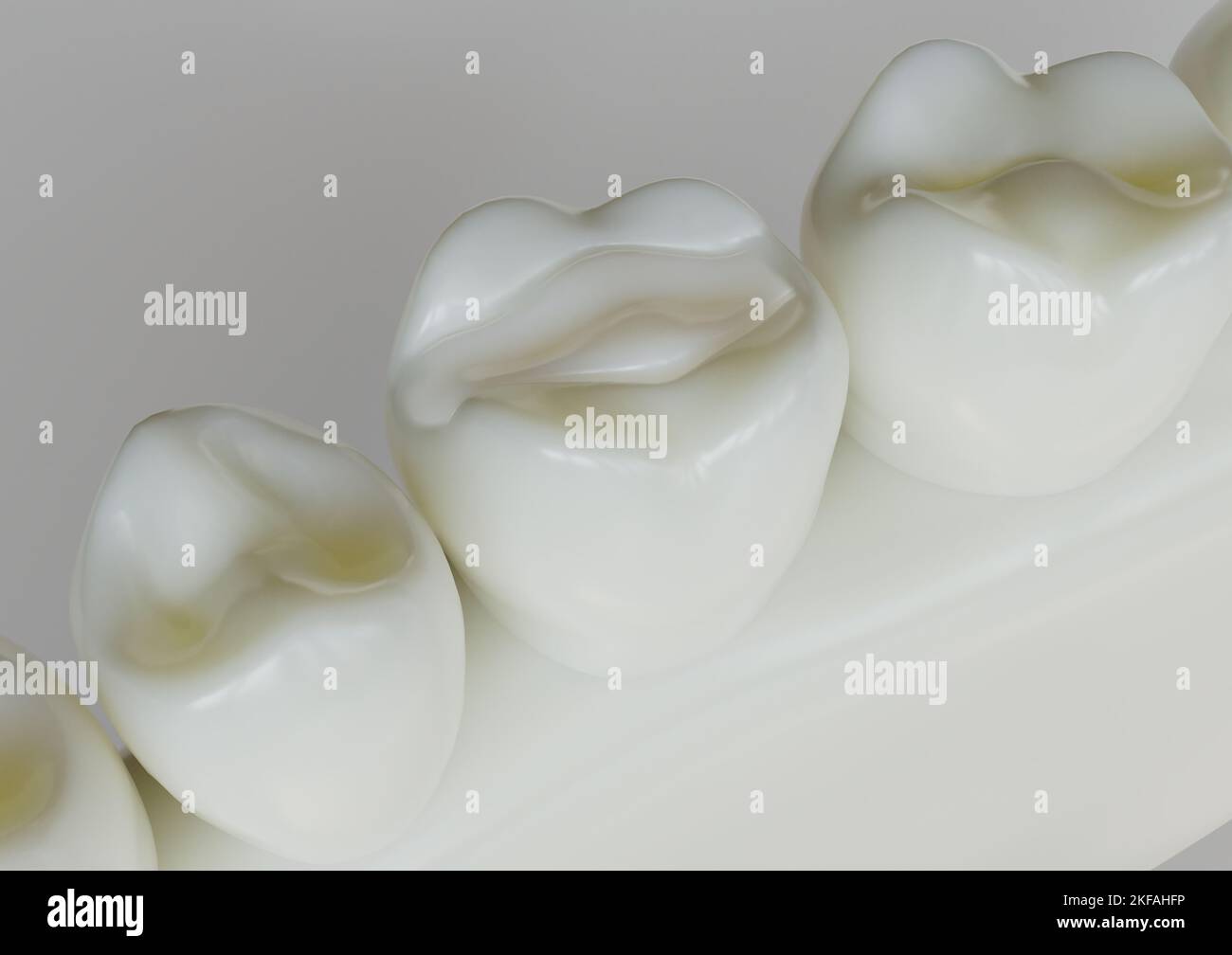 Ceramic Inlay crown in a tooth- 3D Rendering Stock Photo - Alamy