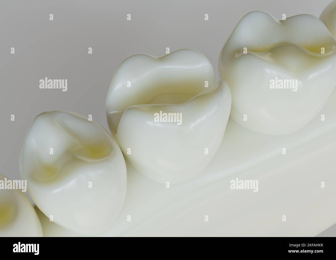 removed amalgam filling from a tooth- 3D Rendering Stock Photo - Alamy
