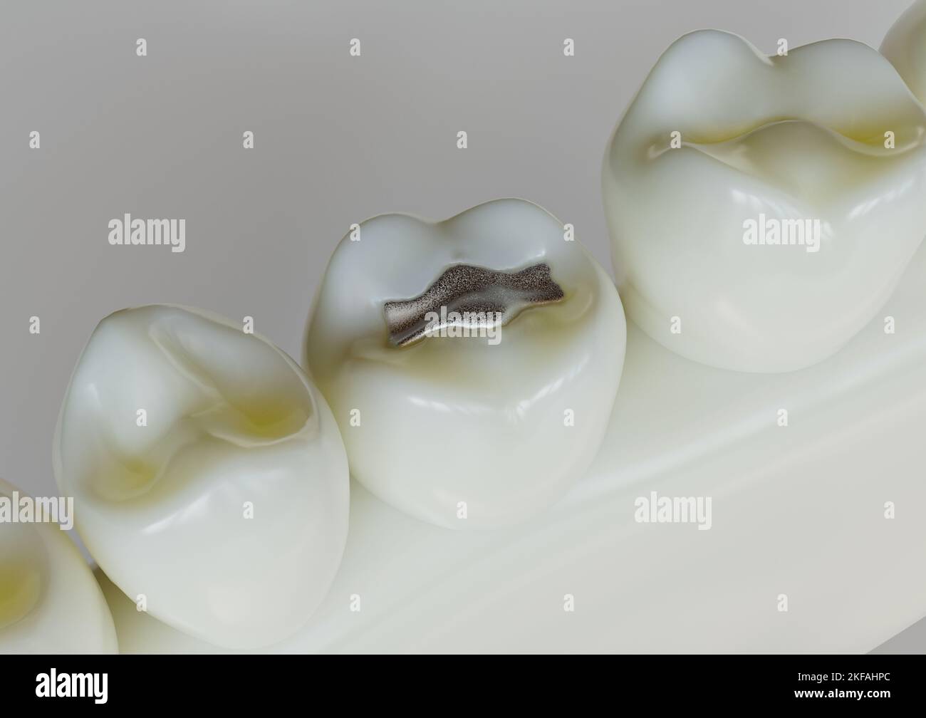 Amalgam restorationn in a tooth - 3D Rendering Stock Photo - Alamy