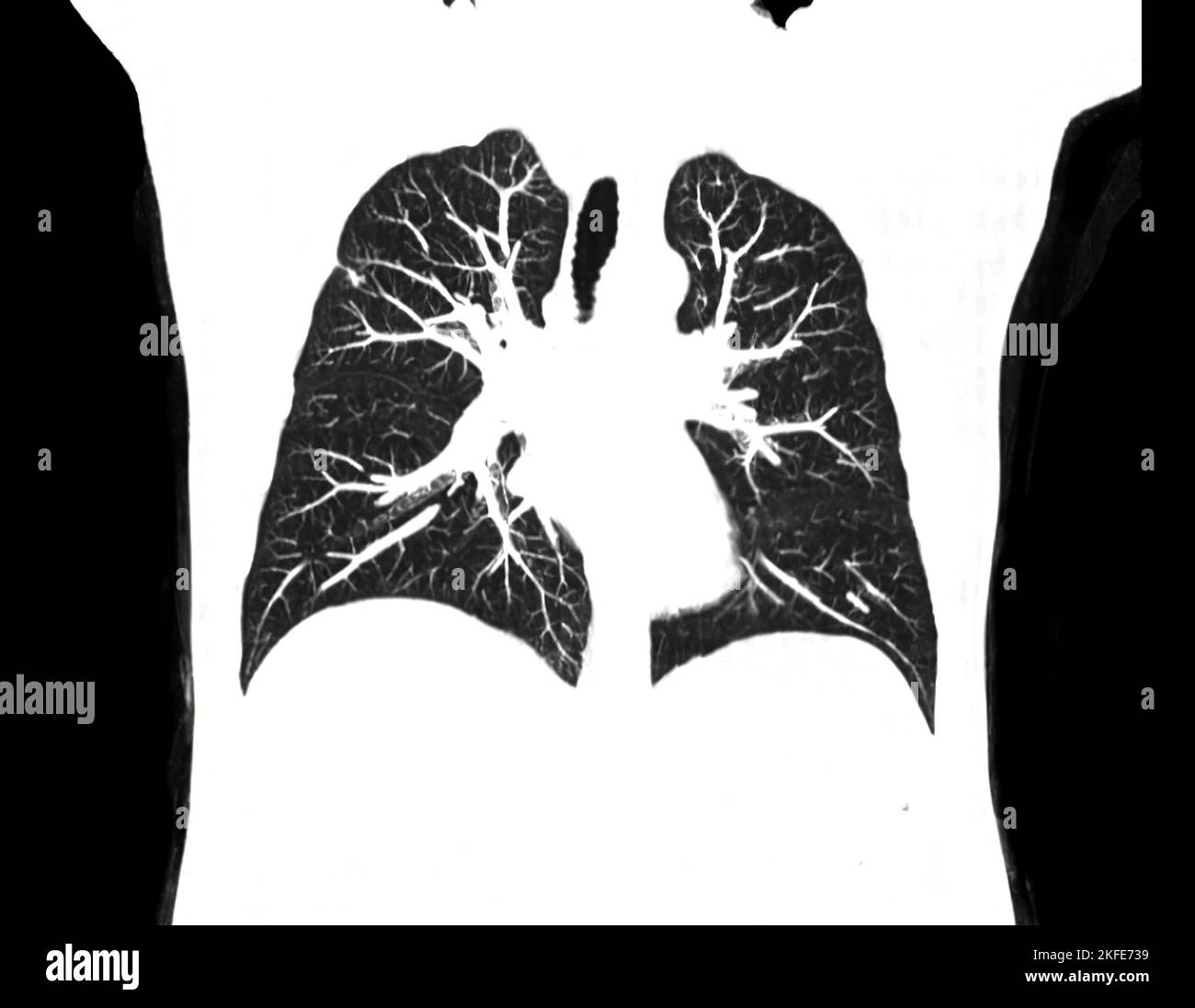 CT scan of Chest or lung coronal view at radiology department in ...