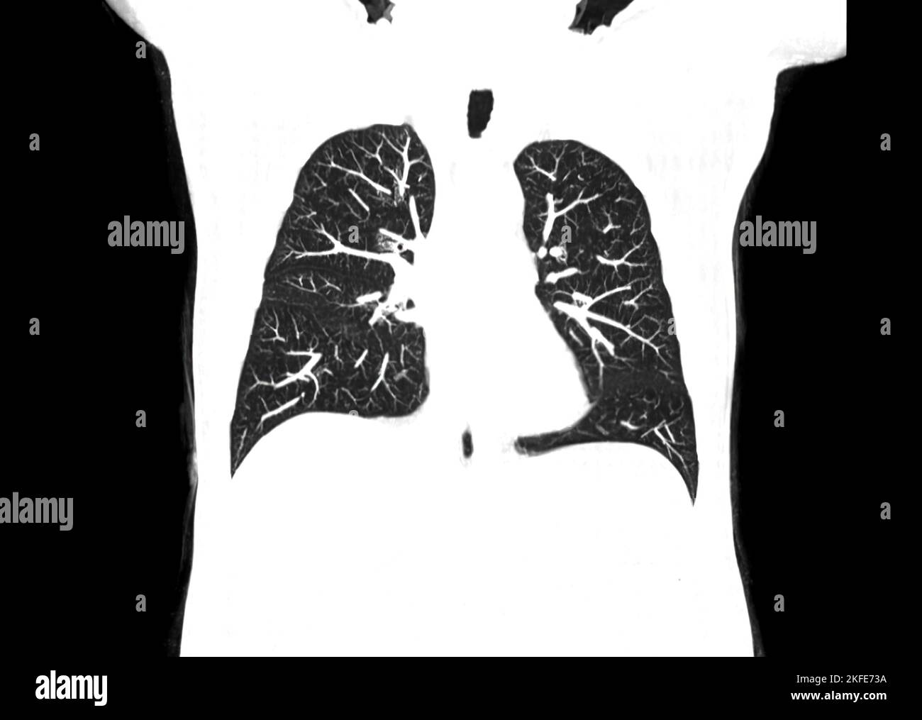 CT scan of Chest or lung coronal view at radiology department in ...