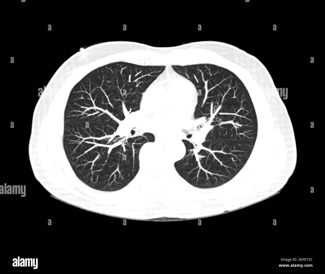 Pulmonary embolism ct scan hi-res stock photography and images - Alamy