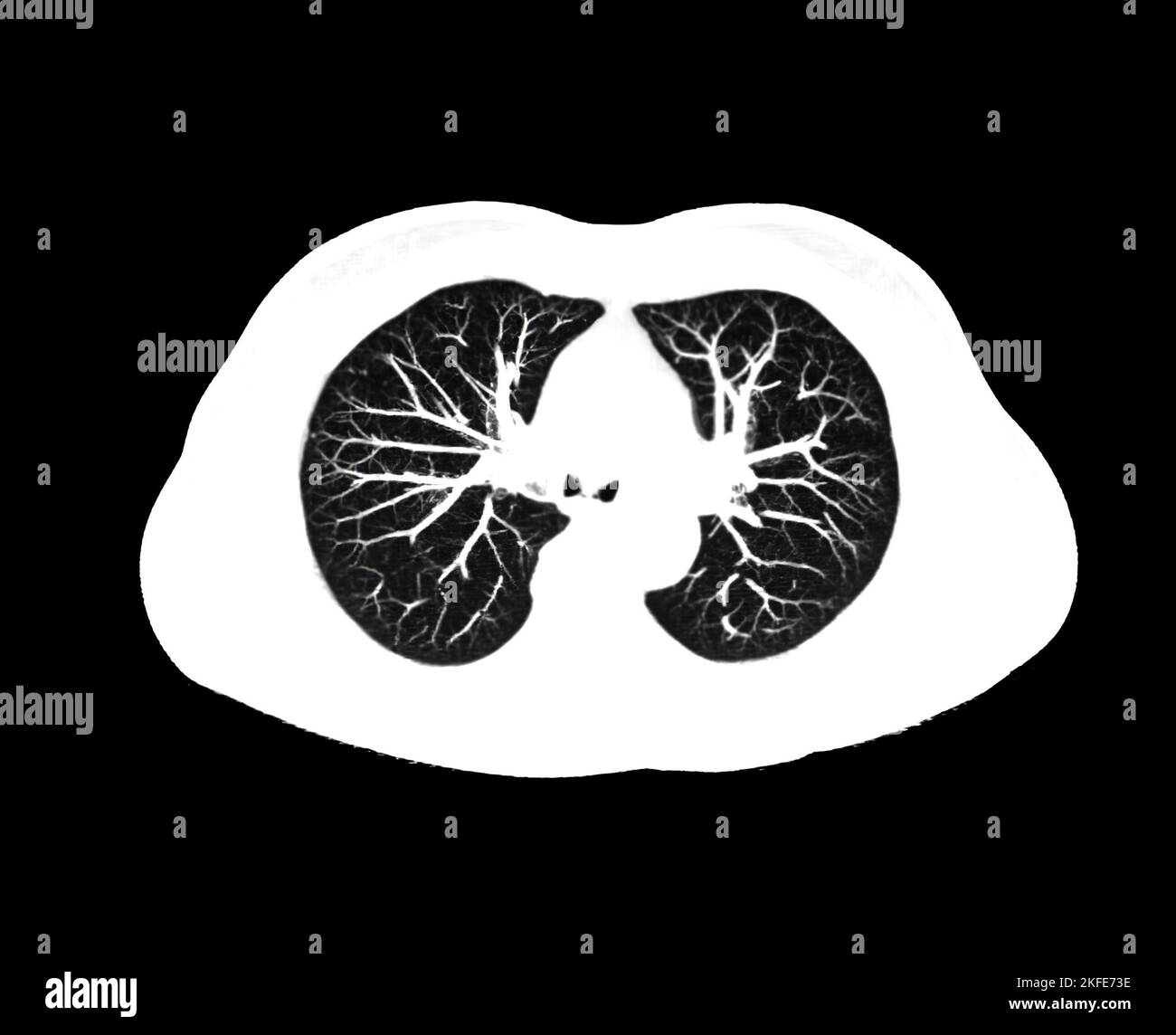 CT scan of Chest or lung axial view at radiology department in hospital ...