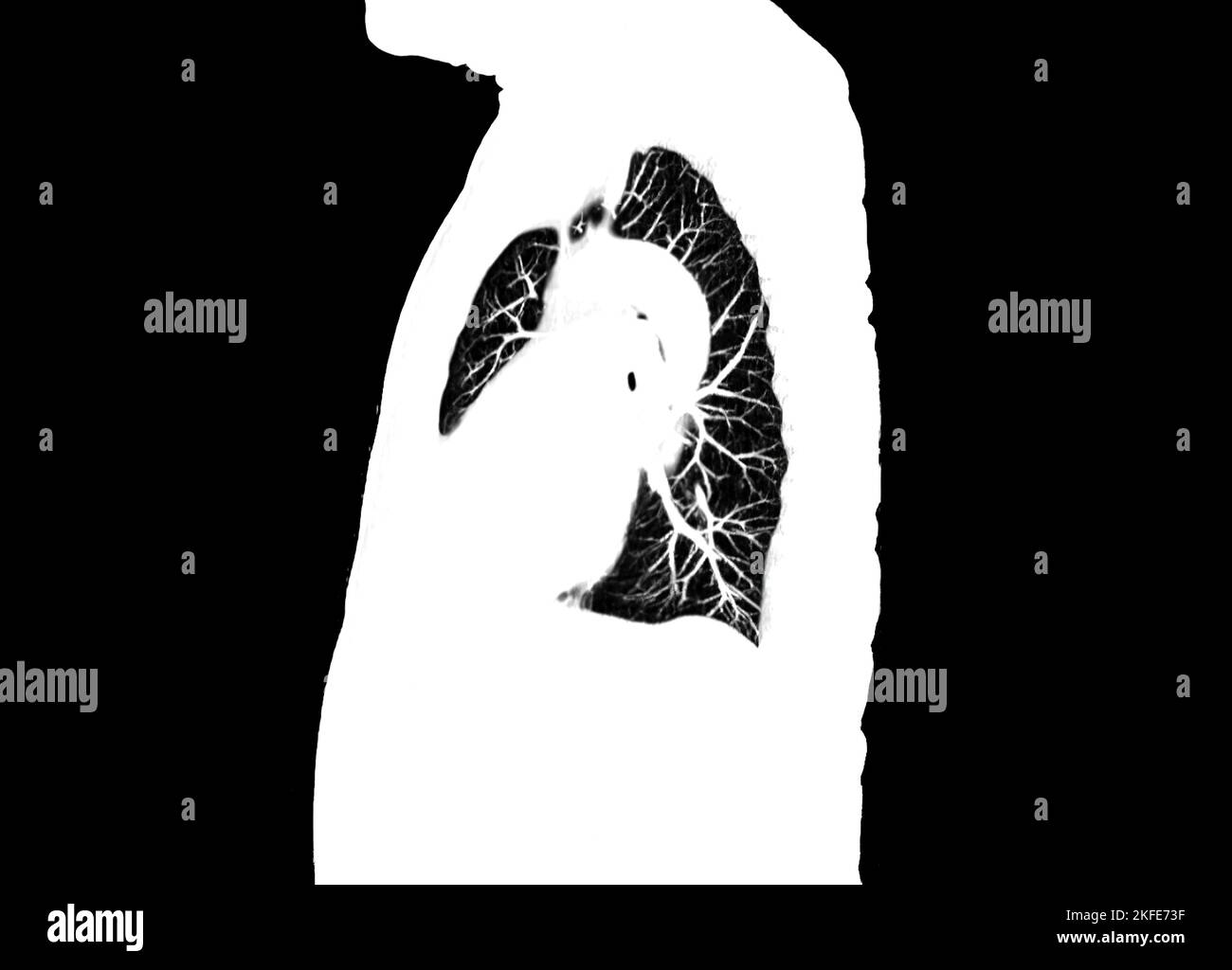 CT scan of Chest or lung sagittal view at radiology department in ...