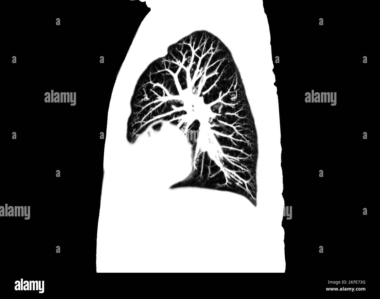 CT scan of Chest or lung sagittal view at radiology department in ...