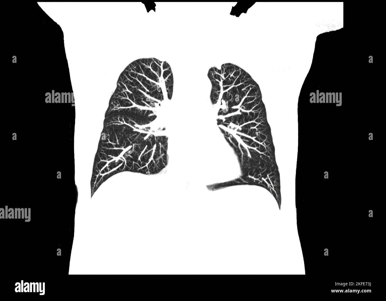 CT scan of Chest or lung coronal view at radiology department in ...