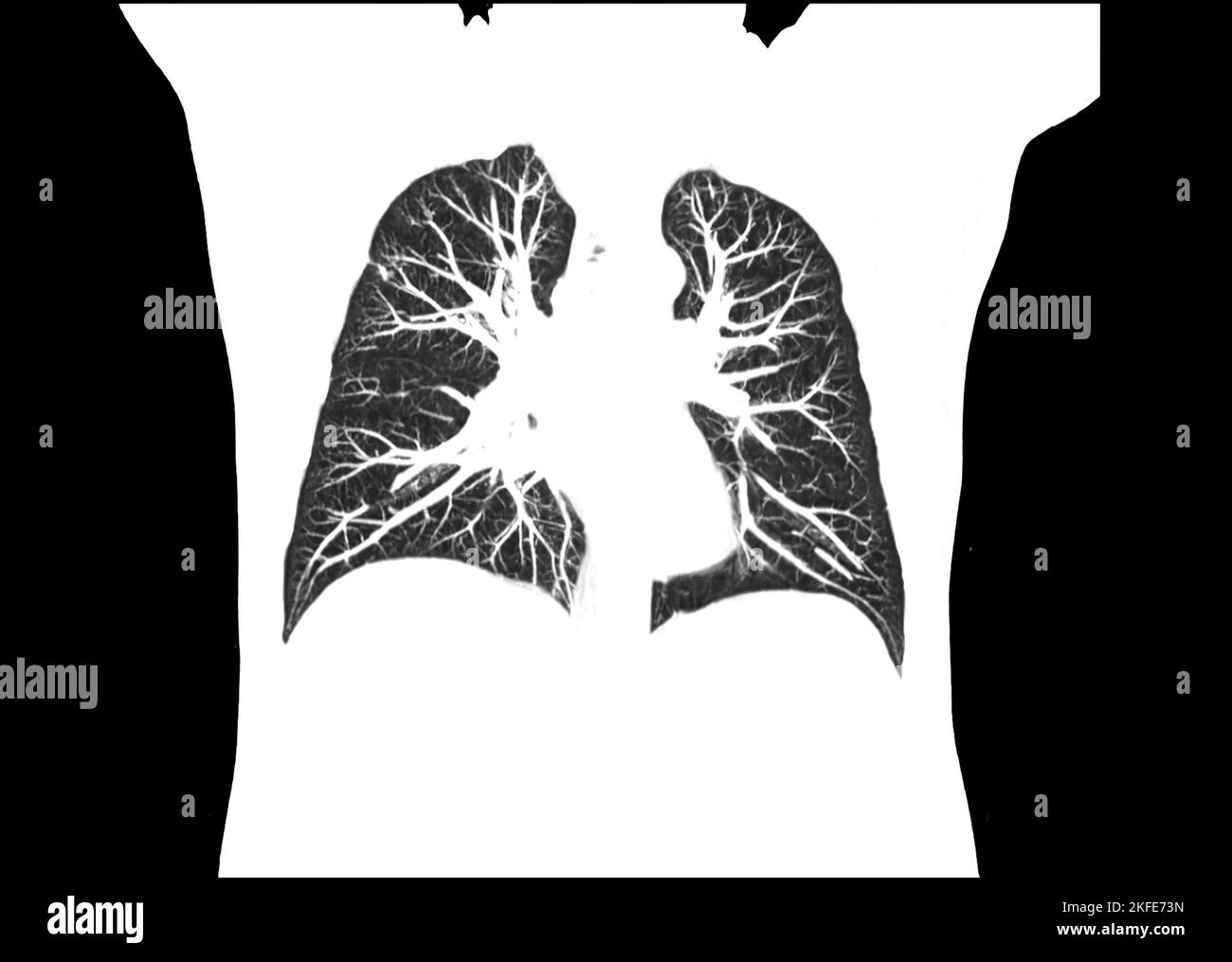 CT scan of Chest or lung coronal view at radiology department in ...