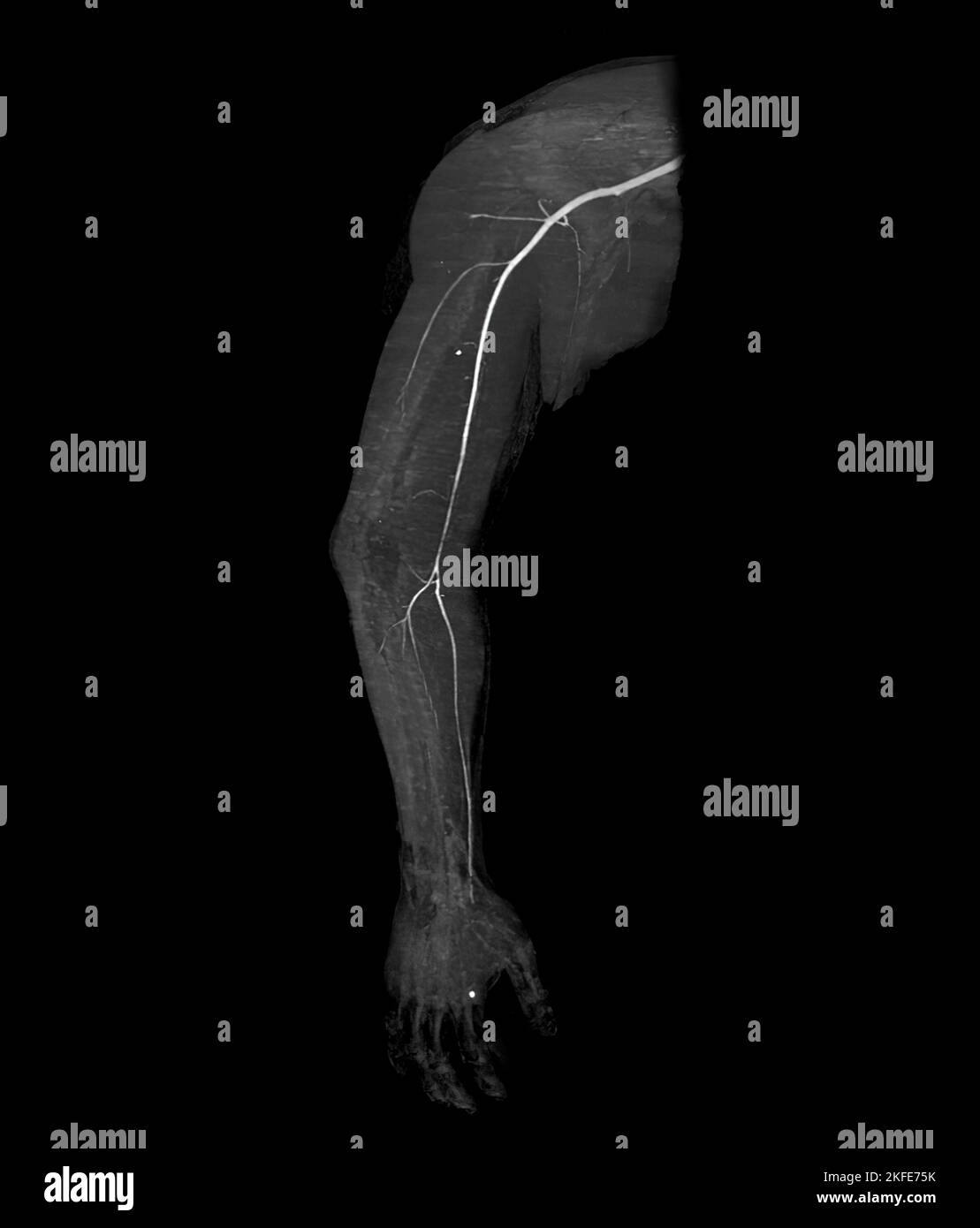 CTA brachial artery or CT scan of upper extremity 3D rendering image ...