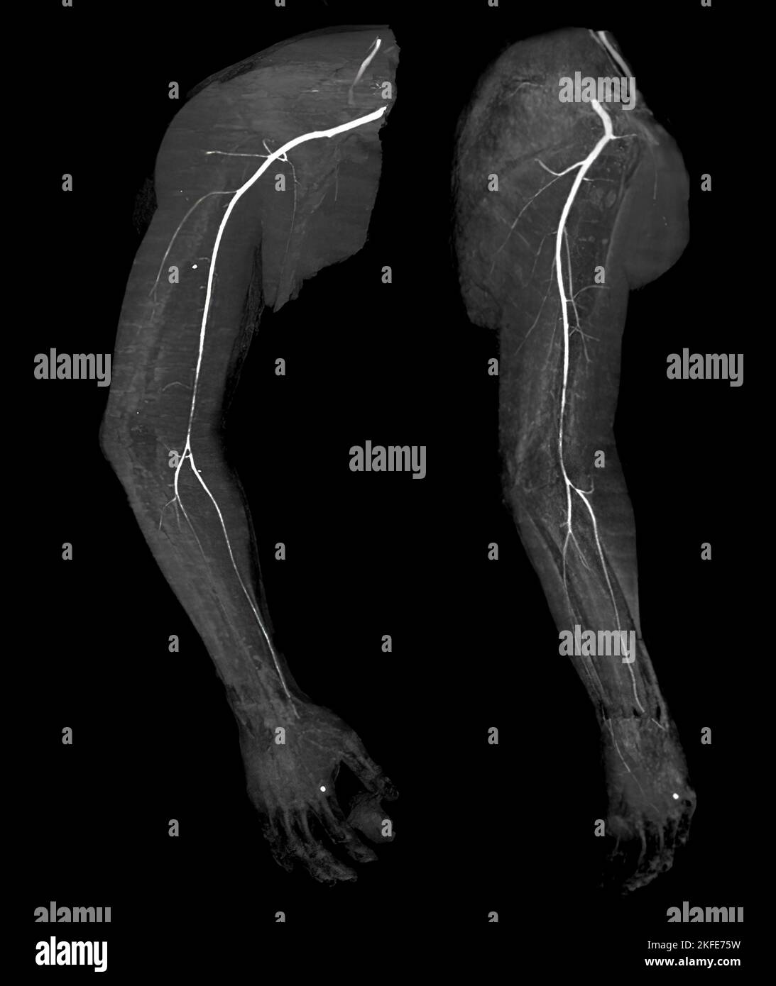 CTA brachial artery or CT scan of upper extremity 3D rendering image ...