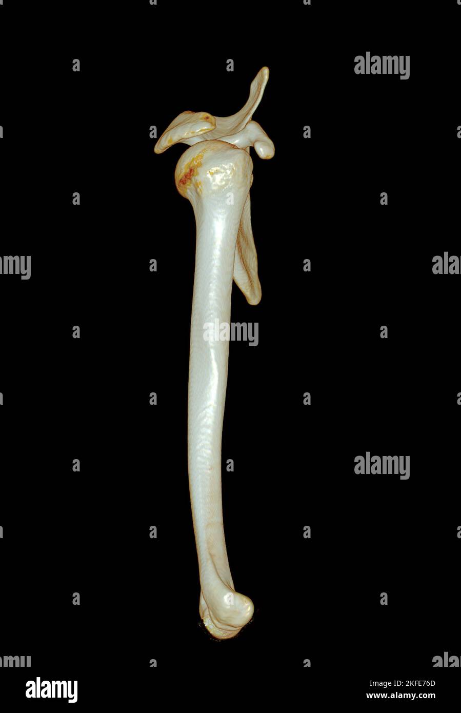 CT SCAN of arm 3D rendering isolated on black background Stock Photo ...