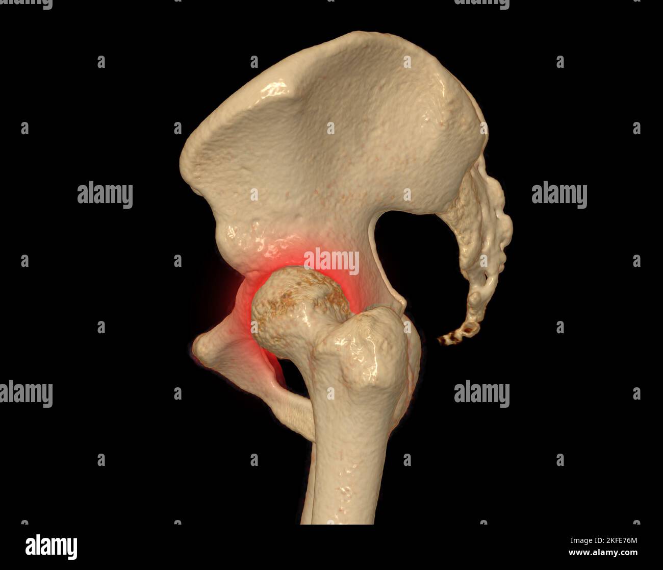 CT scan of Pelvic bone and hip joint 3D rendering for diagnosis ...