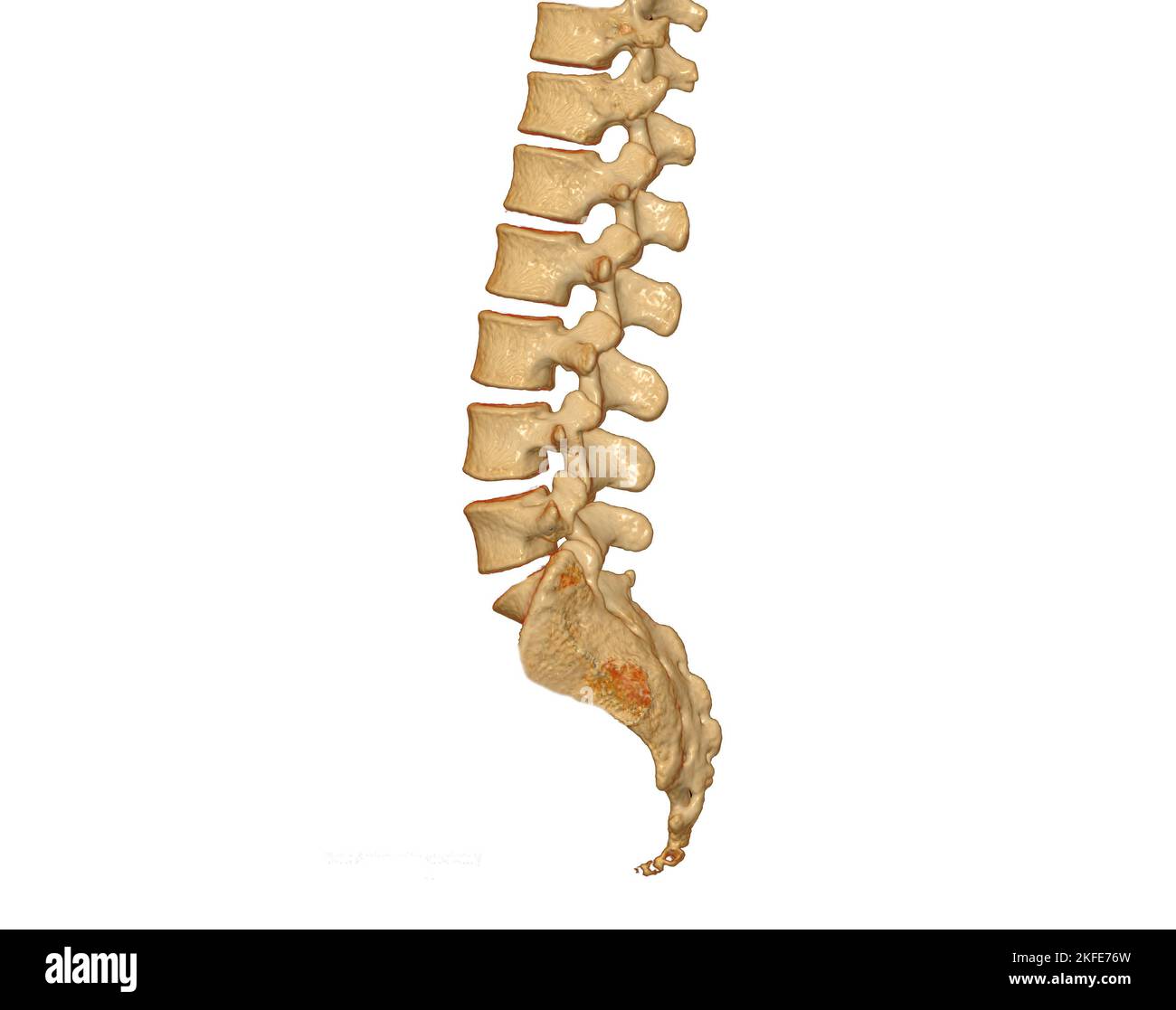 CT scan of lumbar spine 3D rendering showing Profile Human Spine ...