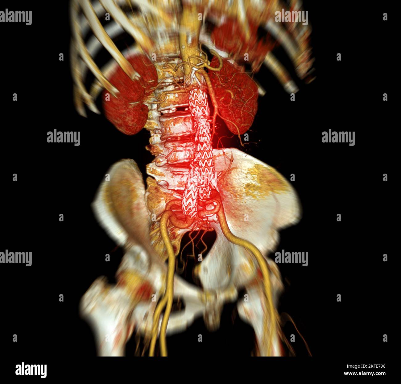 Cta Whole Aorta With Abdominal Aorta Stent Graft Compare 3d Rendering