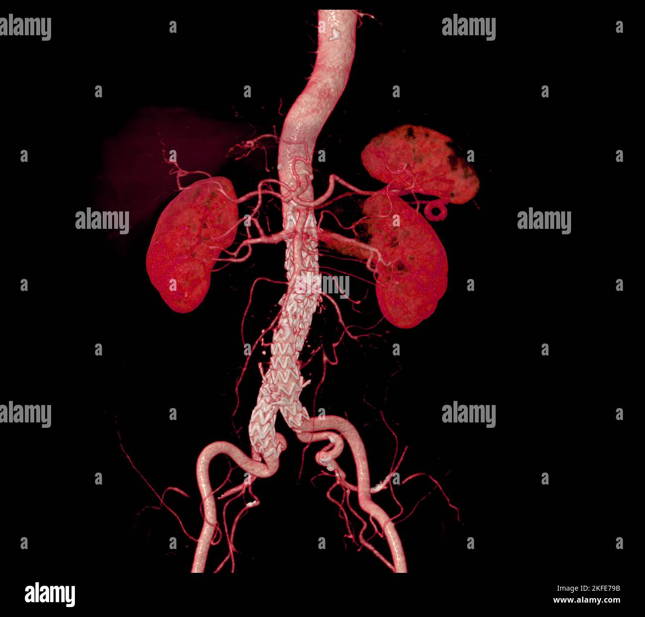 CTA whole aorta with Abdominal aorta stent graft compare 3D rendering ...