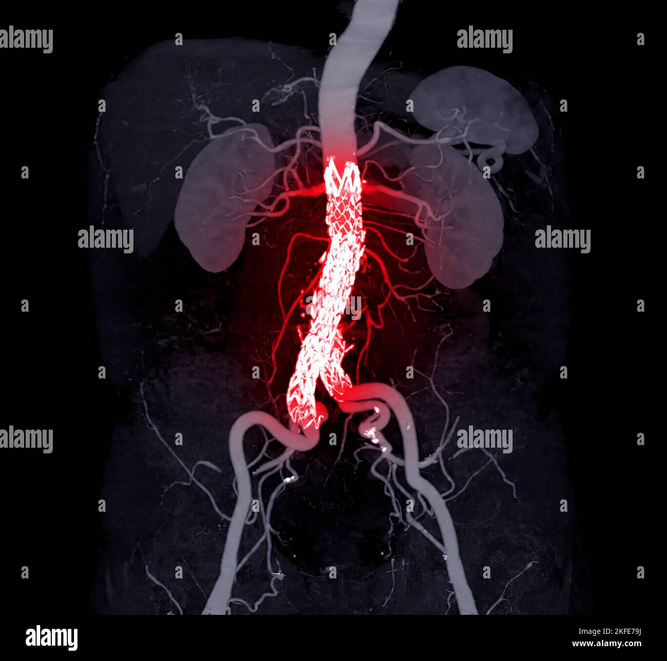CTA whole aorta with Abdominal aorta stent graft compare 3D rendering ...