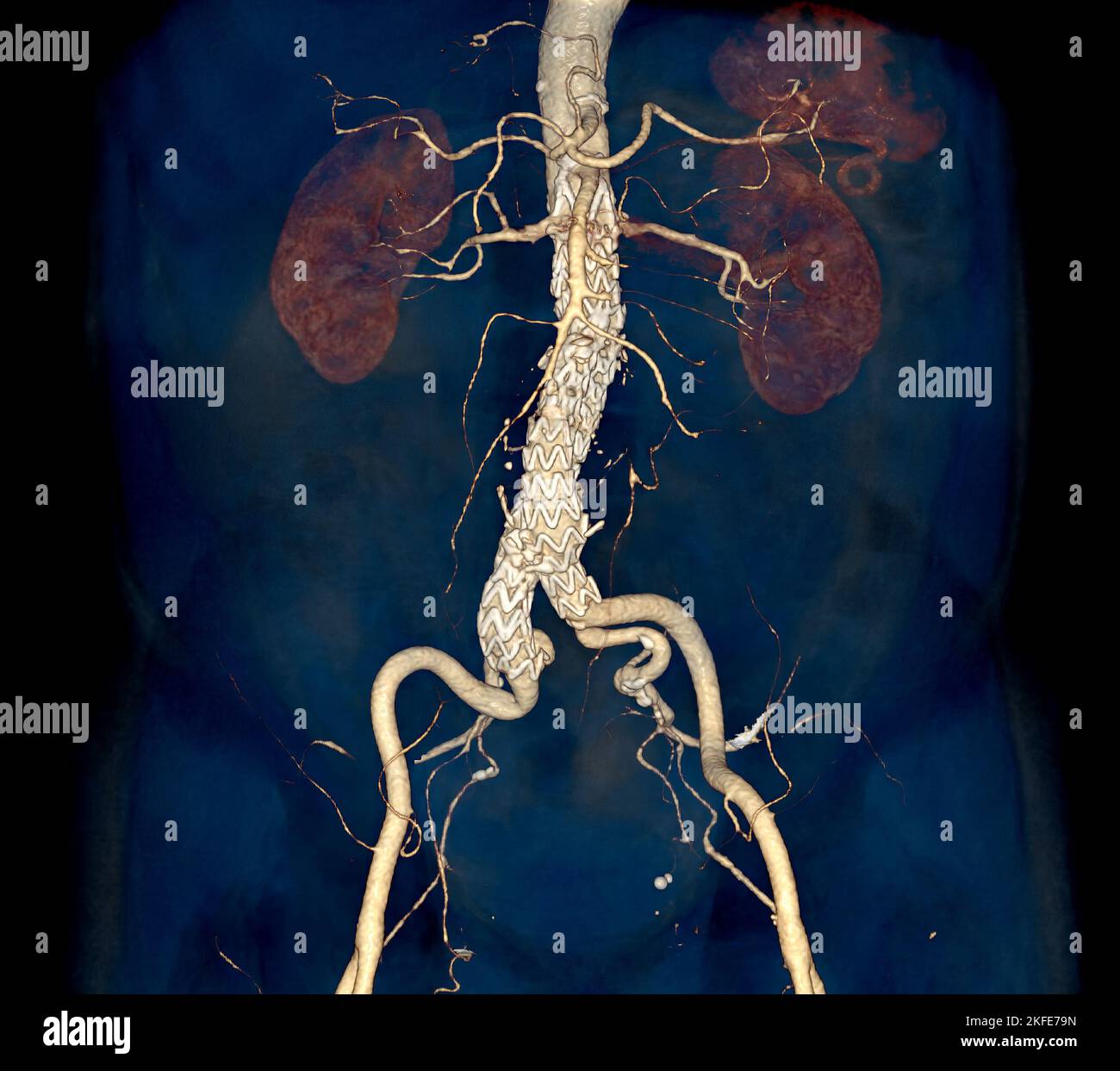 CTA whole aorta with Abdominal aorta stent graft compare 3D rendering ...