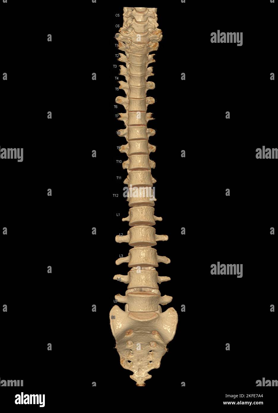 CT scan of Whole spine 3D rendering showing Profile Human Spine ...