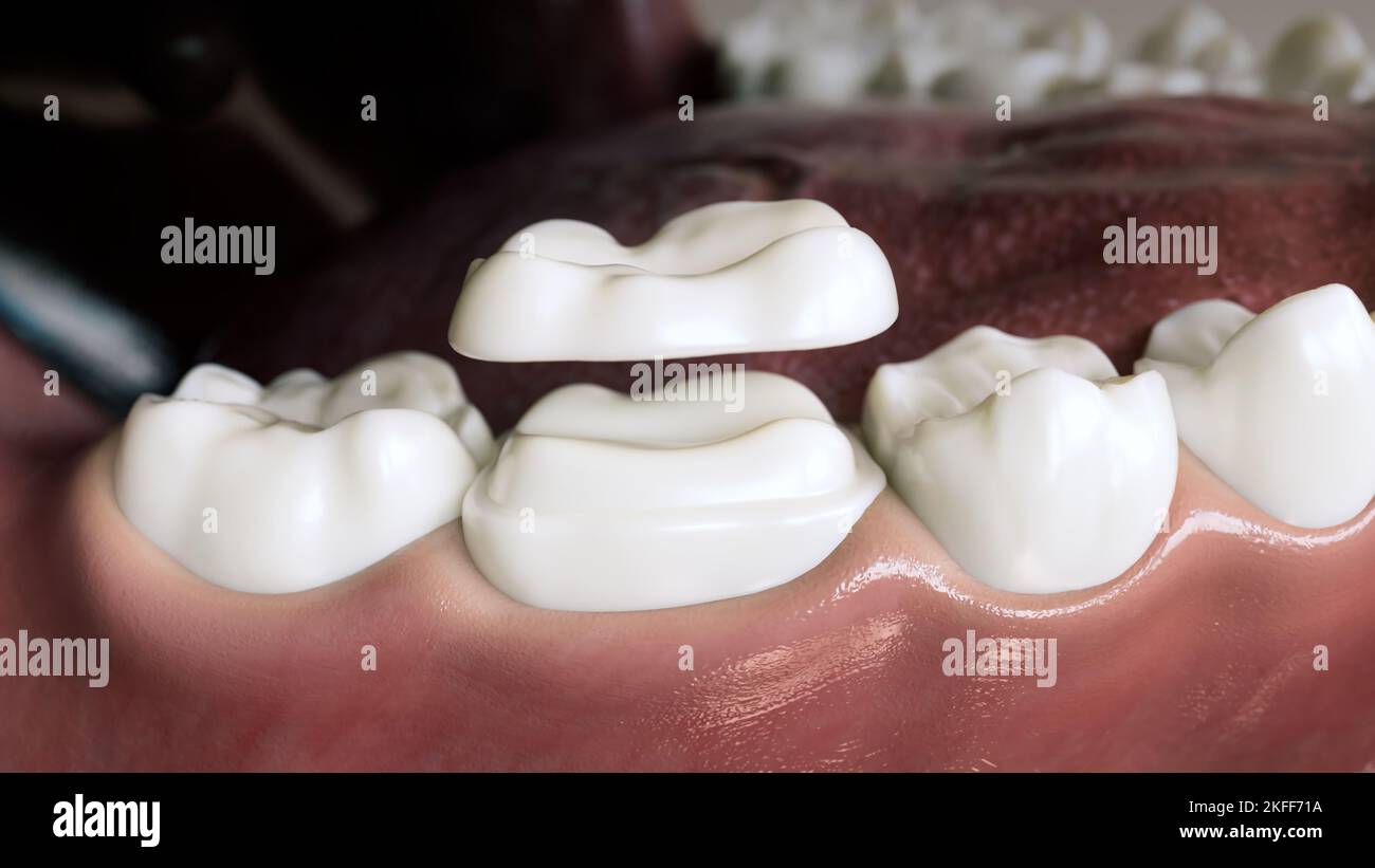 Ceramic Overlay crown over a tooth- 3D Rendering Stock Photo - Alamy