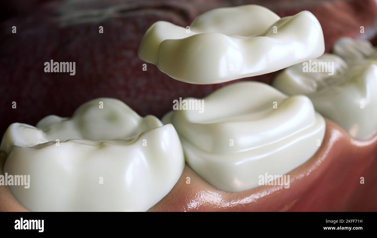 Ceramic Overlay crown over a tooth- 3D Rendering Stock Photo - Alamy