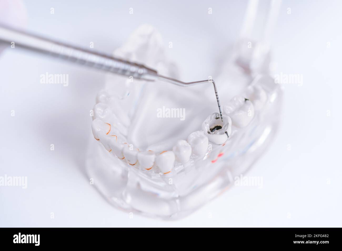 doctor shows the instrument on caries in the teeth Stock Photo - Alamy
