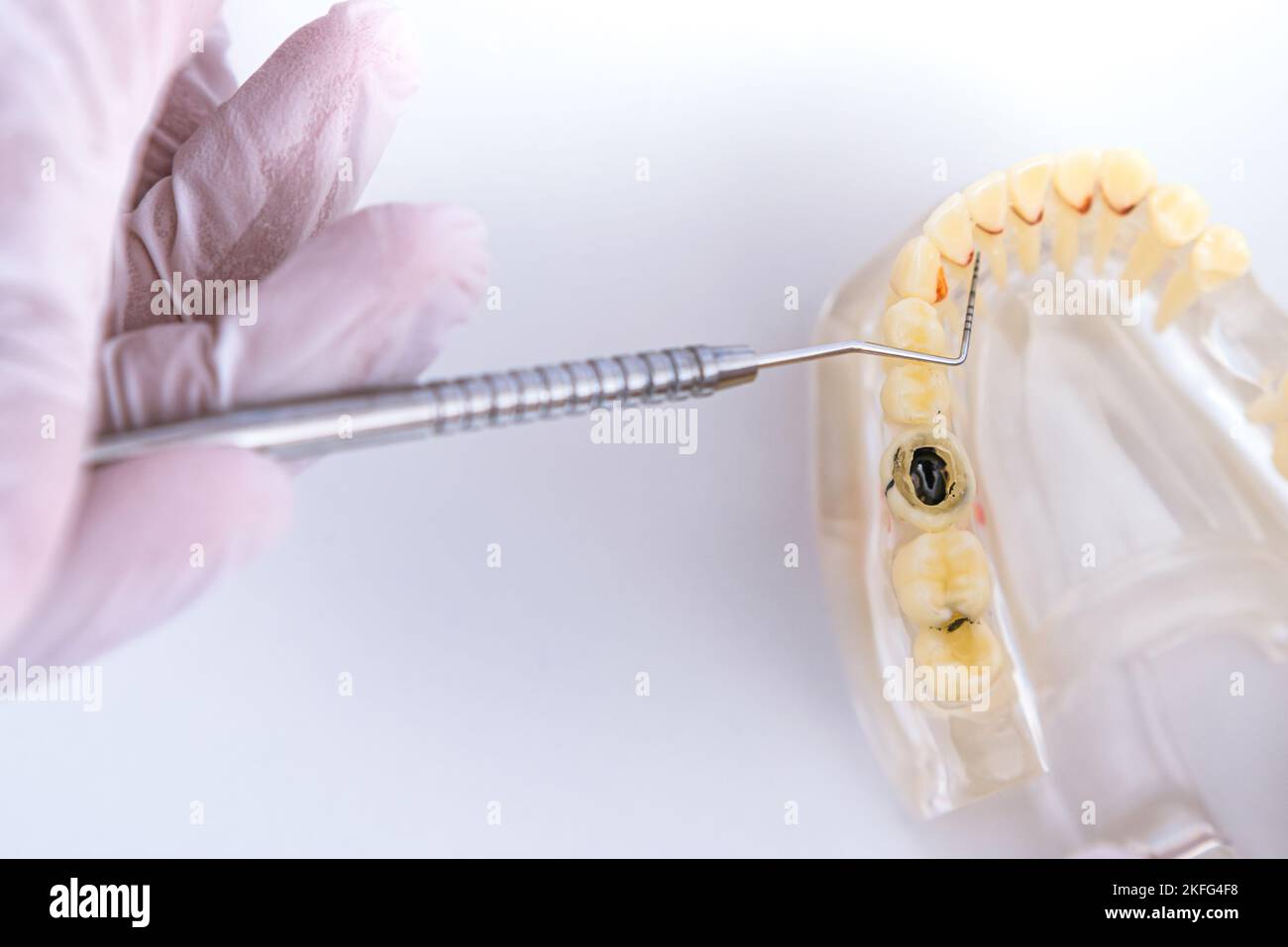 doctor shows the instrument on caries in the teeth Stock Photo - Alamy