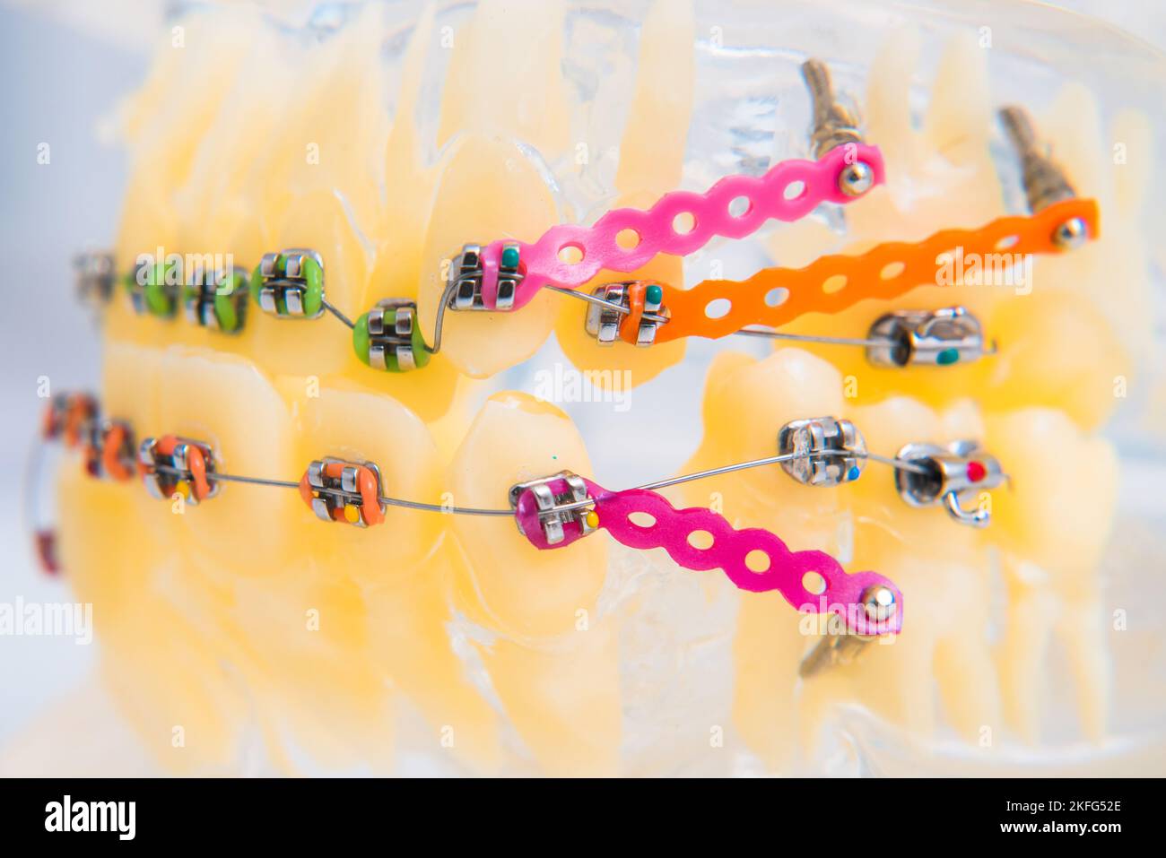 macro photography shows how the braces are arranged Stock Photo - Alamy