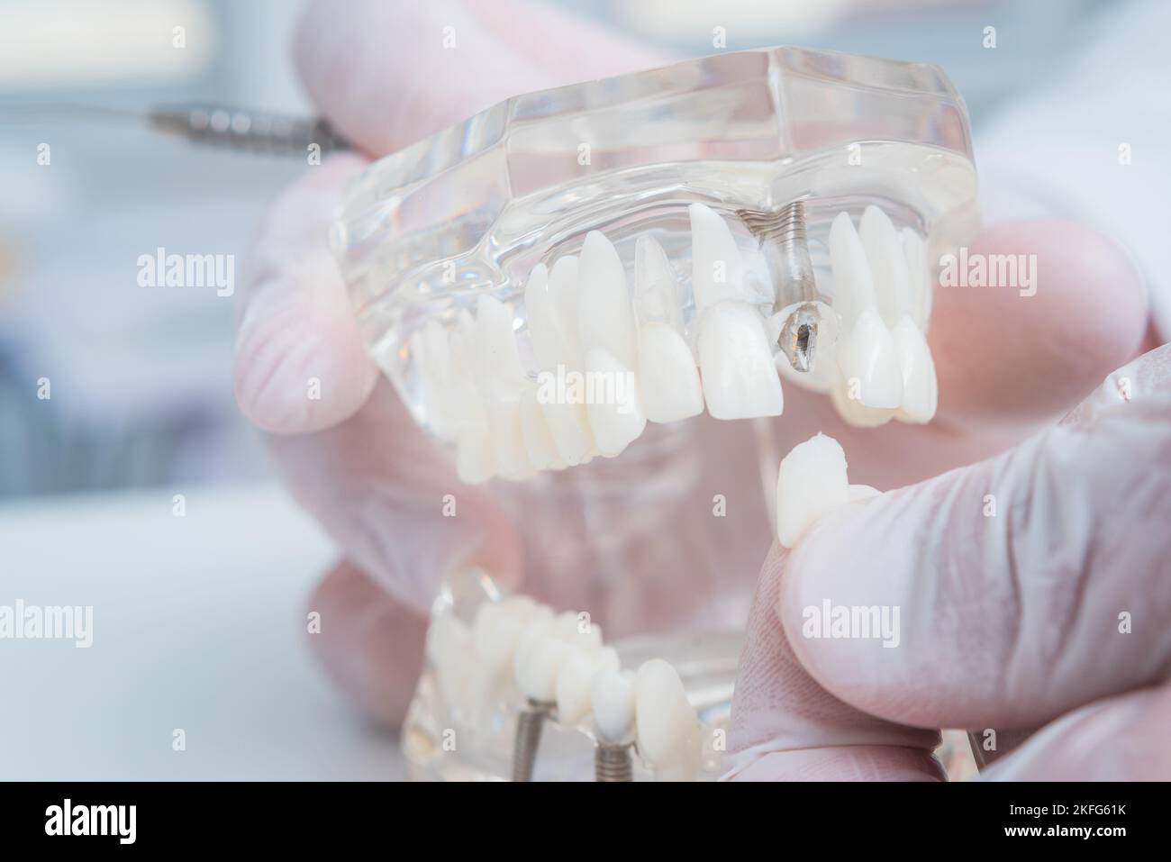 the orthodontist holds a model of teeth with implants in his hand and ...