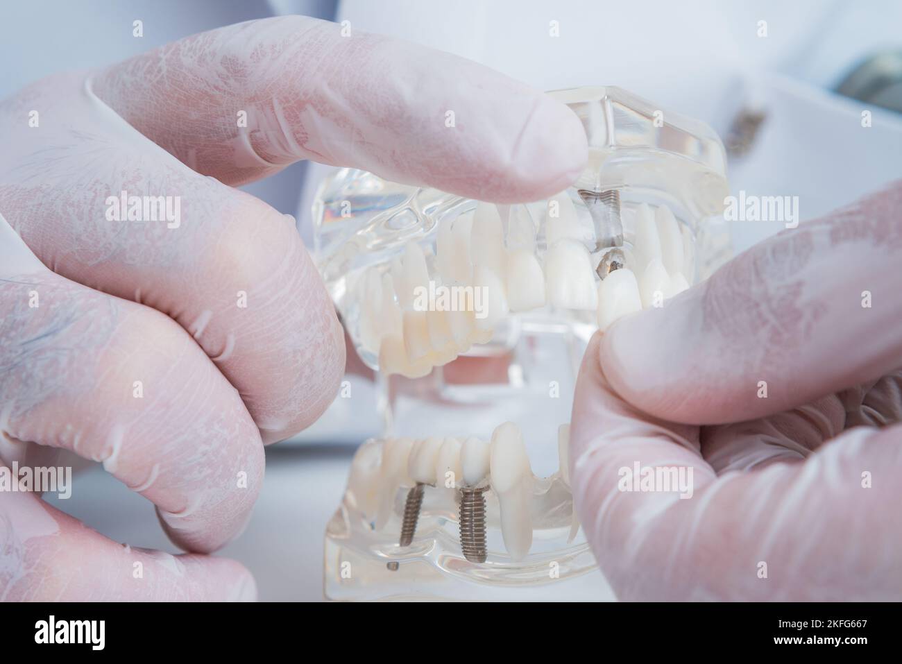 the orthodontist holds a model of teeth with implants in his hand and ...