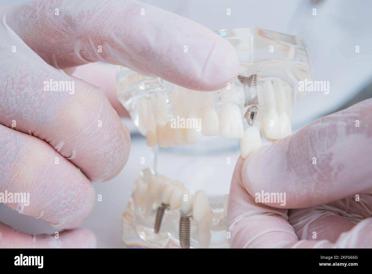 the orthodontist holds a model of teeth with implants in his hand and ...