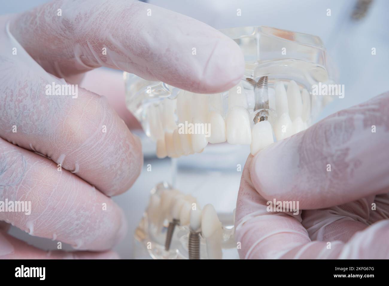 the orthodontist holds a model of teeth with implants in his hand and ...