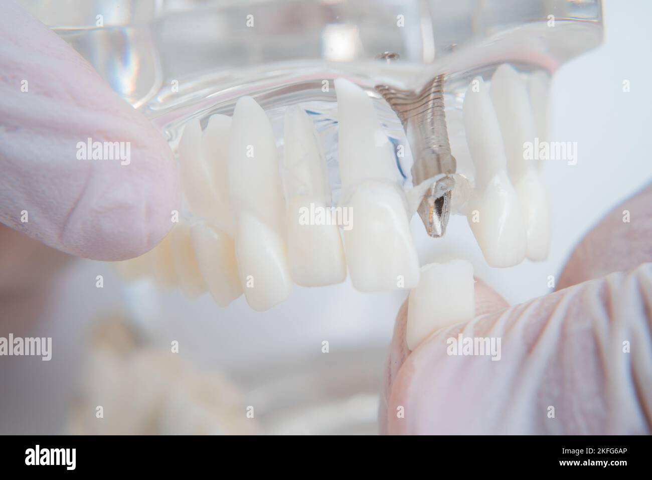 the orthodontist holds a model of teeth with implants in his hand and ...