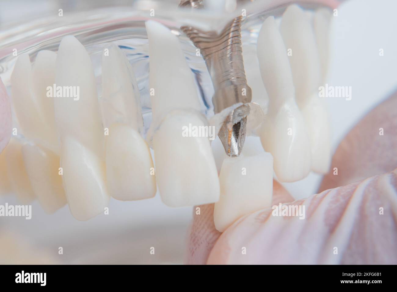 the orthodontist holds a model of teeth with implants in his hand and ...