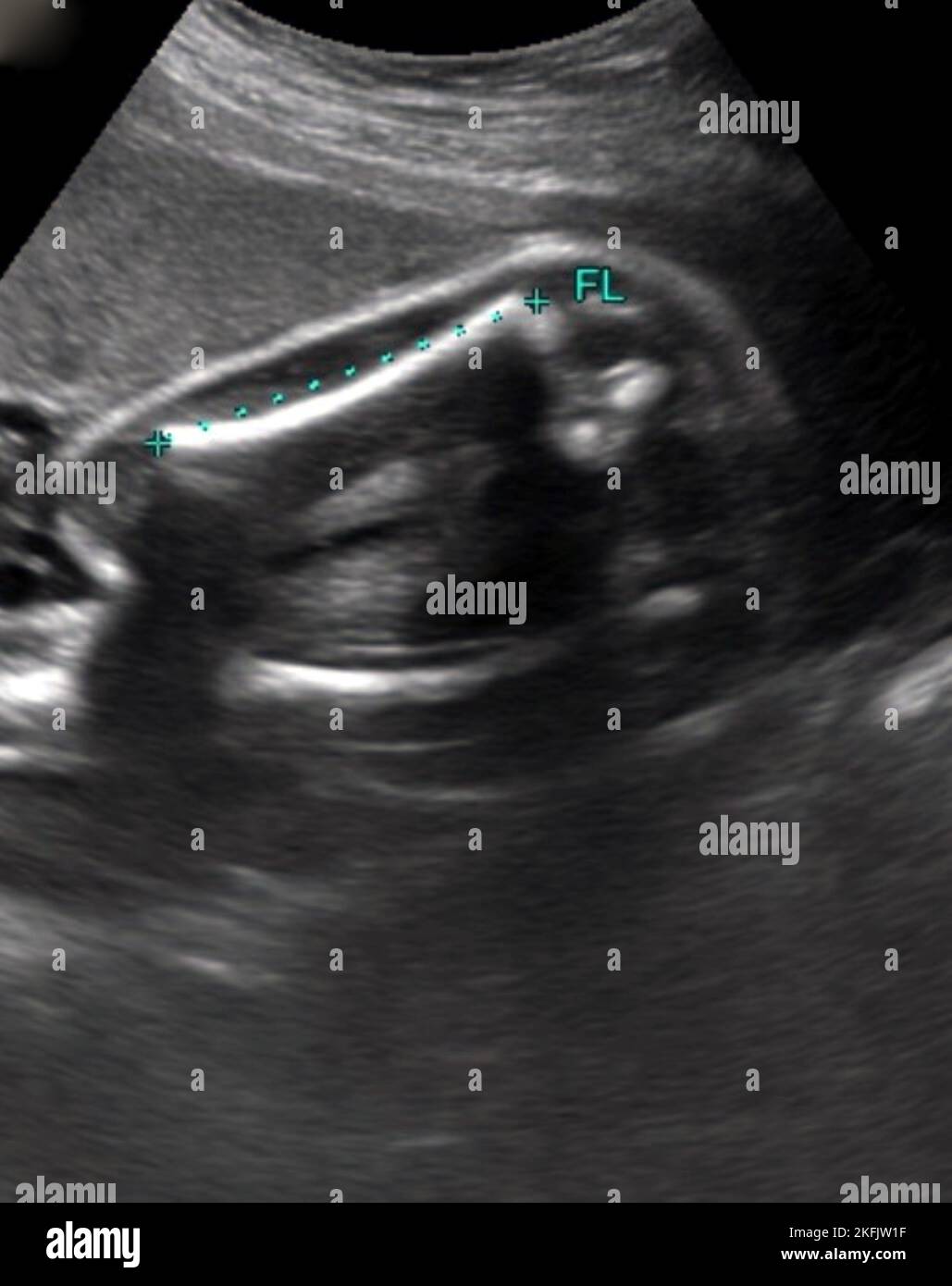 Foetal thigh bone, ultrasound scan Stock Photo - Alamy